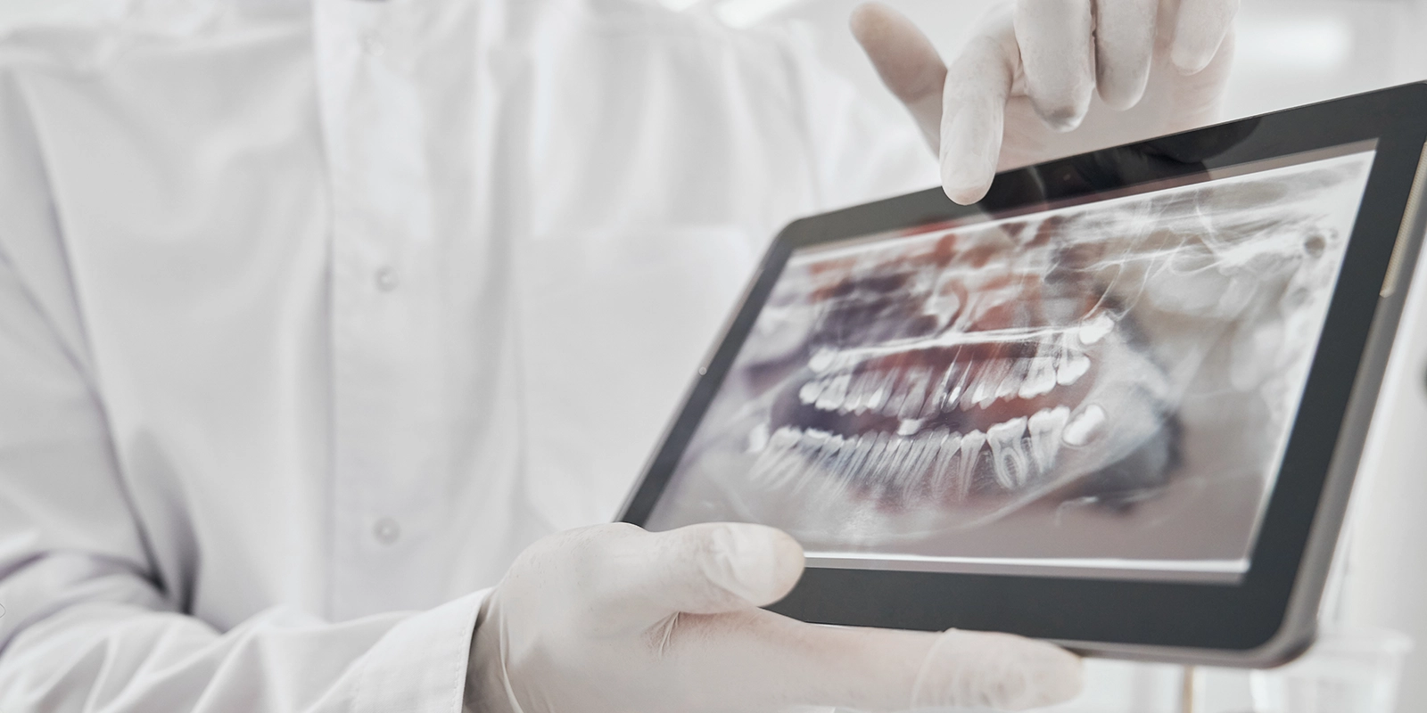 Wisdom Teeth Extractions - Dental Crafted