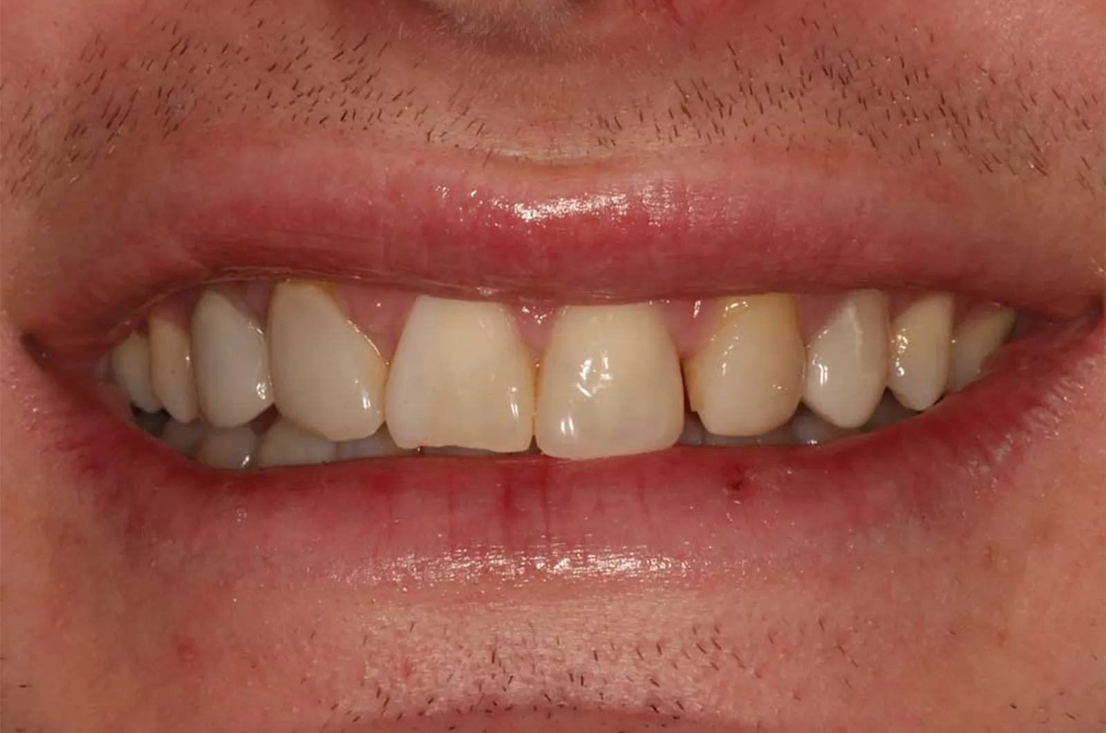 Smile Makeover - Dental Crafted